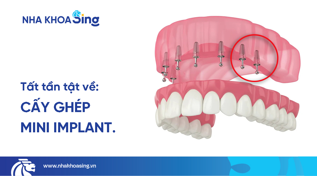 Cấy ghép mini implant là gì? Khác gì với implant bình thường?