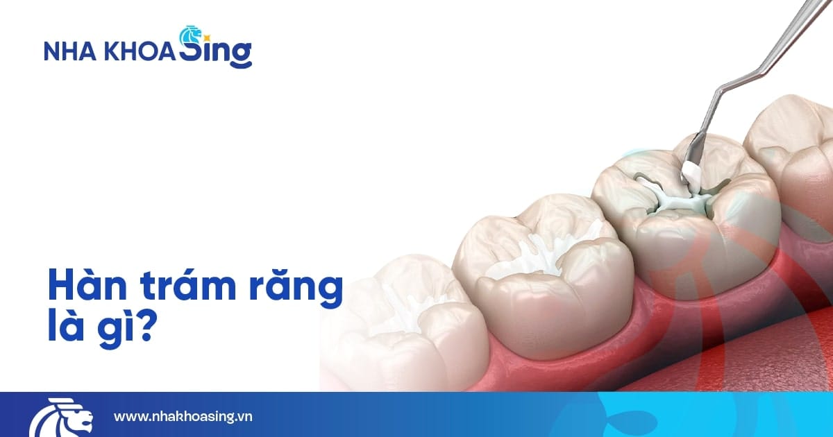 Trám răng là gì? Tất tần tật về trám răng