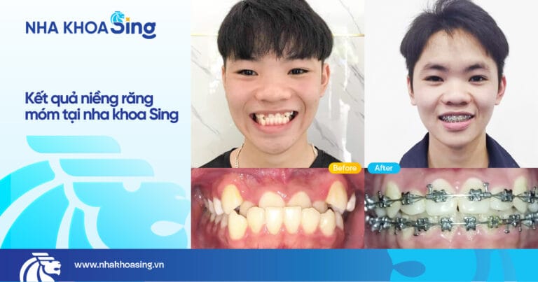 Nha khoa Sing - Nha Khoa Tiêu Chuẩn Singapore