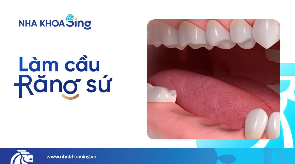 Cầu răng sứ là gì? Review chi tiết và cập nhật bảng giá mới nhất 2025