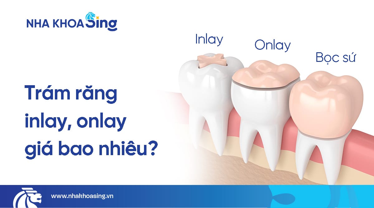 Trám răng Inlay, Onlay giá bao nhiêu? Ưu nhược điểm và lưu ý