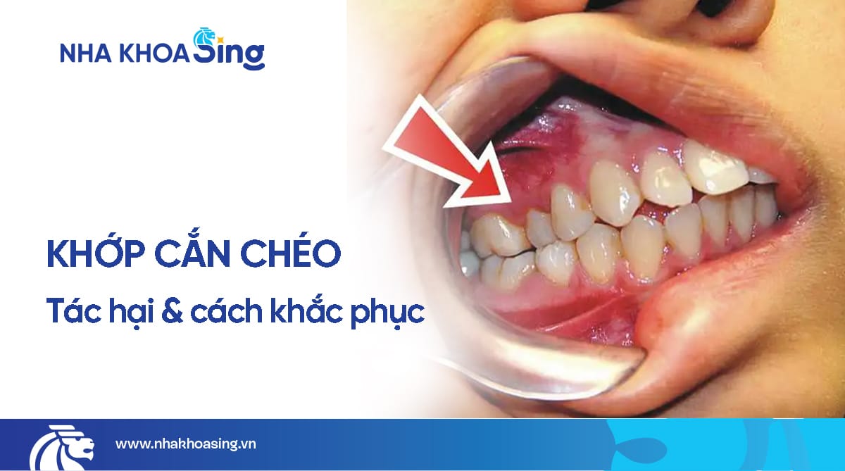 Khớp cắn chéo gây ra tác hại gì? Cách khắc phục hiệu quả