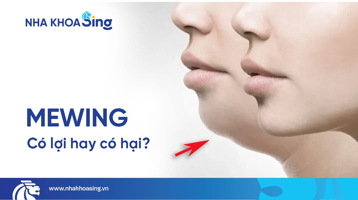 Mewing là gì? Mewing đúng có tác dụng như thế nào?