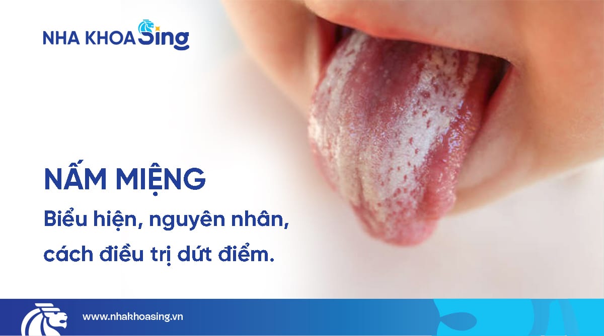 Nấm miệng: Biểu hiện, nguyên nhân và cách điều trị dứt điểm