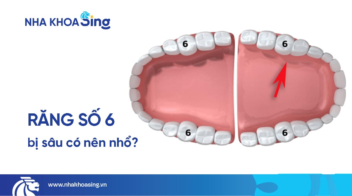 Răng số 6 là răng nào? Có nên nhổ răng số 6 khi bị sâu?