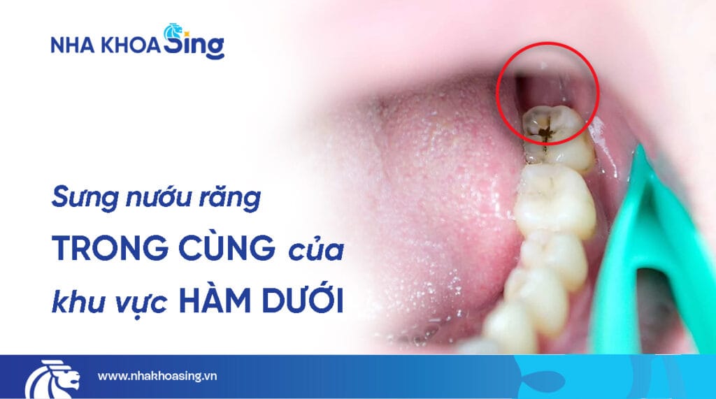 Trám răng là gì? Tất tần tật về trám răng