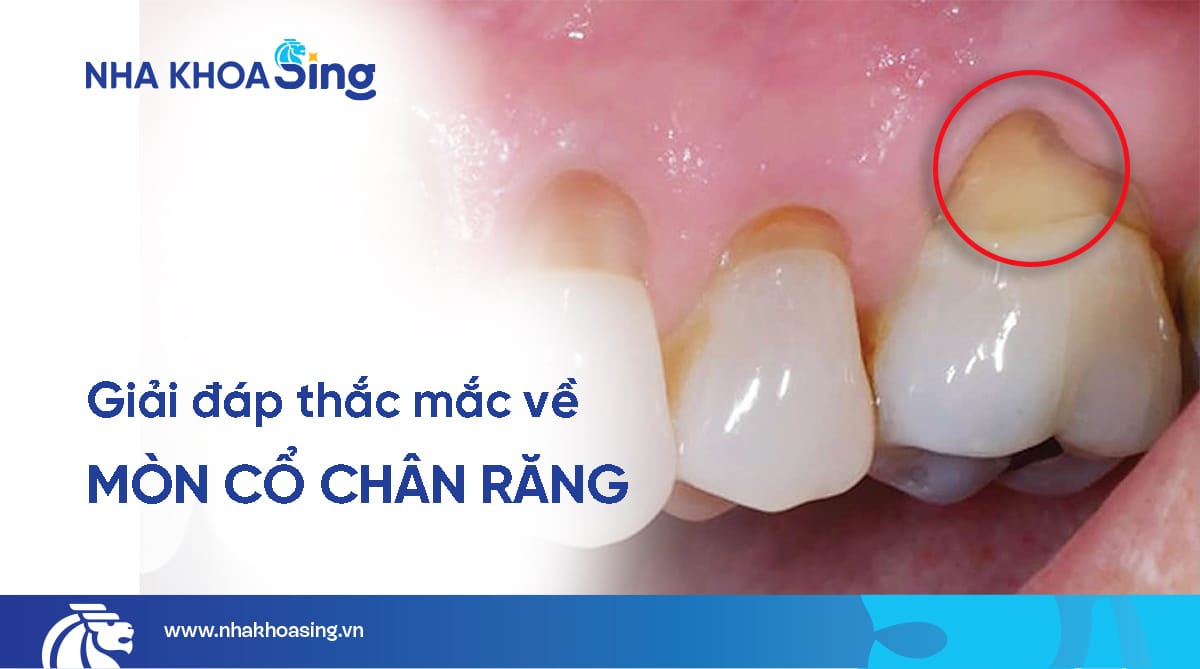 Mòn cổ chân răng: Nguyên nhân, triệu chứng và cách chữa