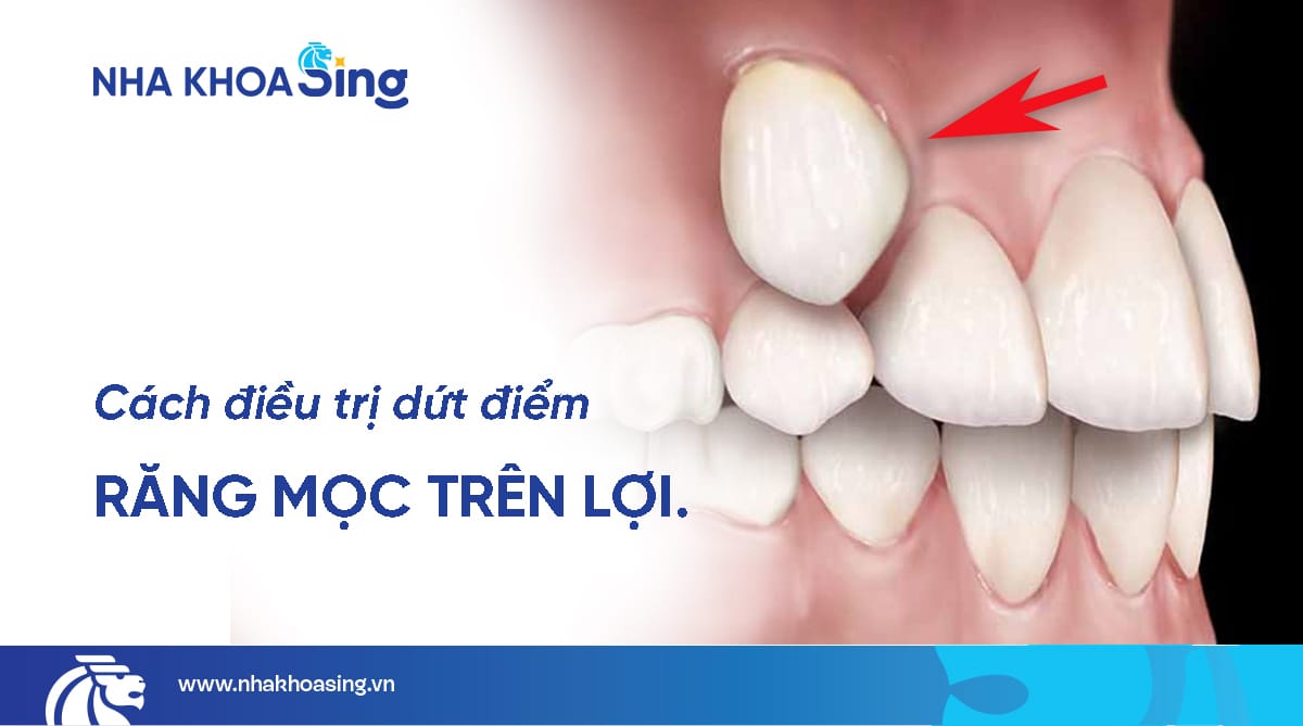 Răng mọc trên lợi: Nguyên nhân, mô tả và cách xử lý hiệu quả