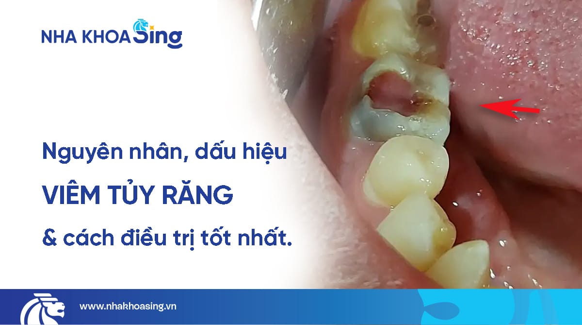 Viêm tủy răng: Nguyên nhân, triệu chứng và cách điều trị